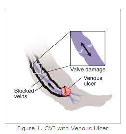 Chronic Venous Insufficiency | Cardiac Surgery & Lung Transplantation
