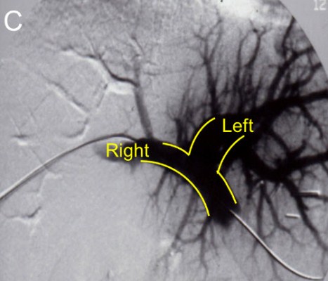 Portal Vein Embolization (PVE) | Cardiac Surgery & Lung Transplantation